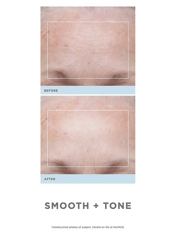 NuFACE Trinity Wrinkle Reducer