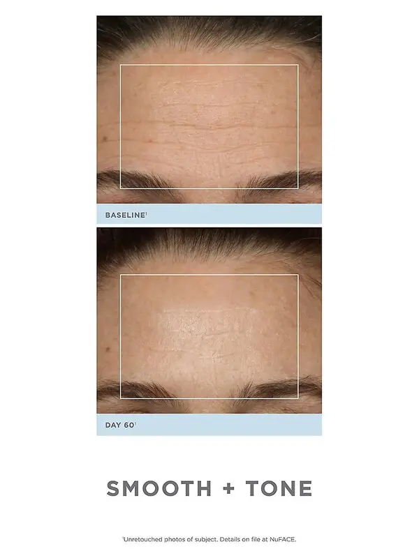 NuFACE Trinity Wrinkle Reducer