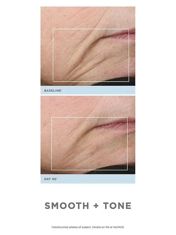NuFACE Trinity Wrinkle Reducer