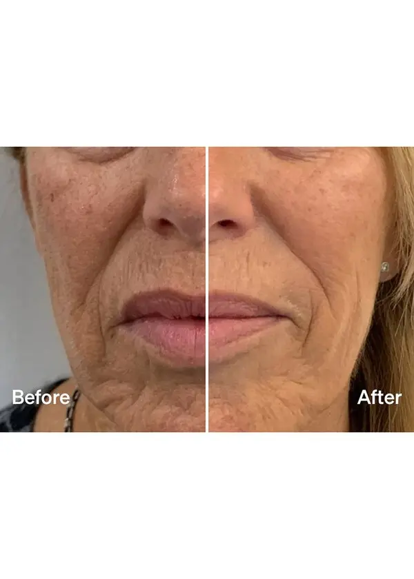LYMA Laser Mist & Glide Refill Days - 30