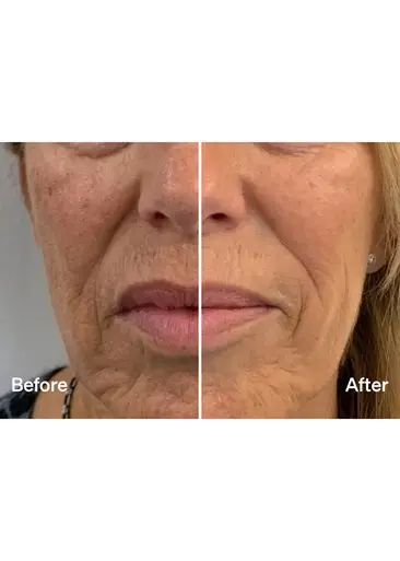 LYMA Laser Mist & Glide Refill Days - 60