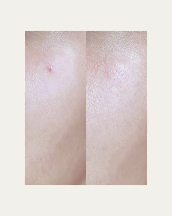 SKIN INC SUPPLEMENT BAR Deepcare Blemish Sos Patches, 12 Count