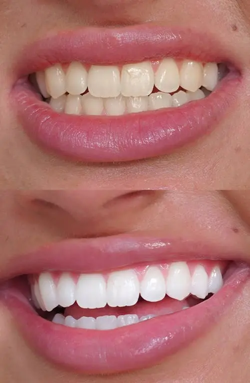 SNOW Diamond Wireless Teeth Whitening Kit $299 Value