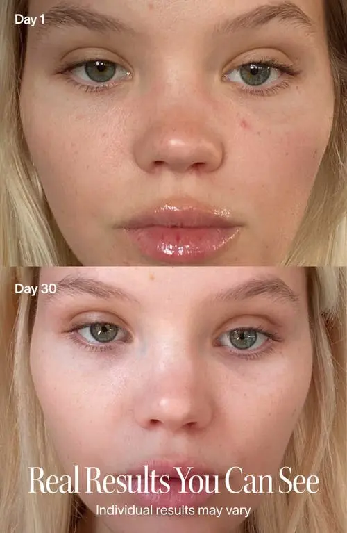 SOLAWAVE 3 Minute Light Therapy Acne Spot Treatment
