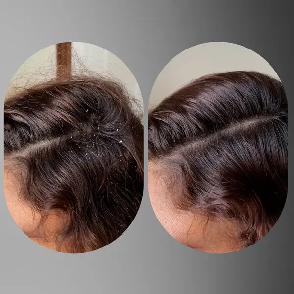 ACT+ACRE Cold Processed Scalp Renew Treatment