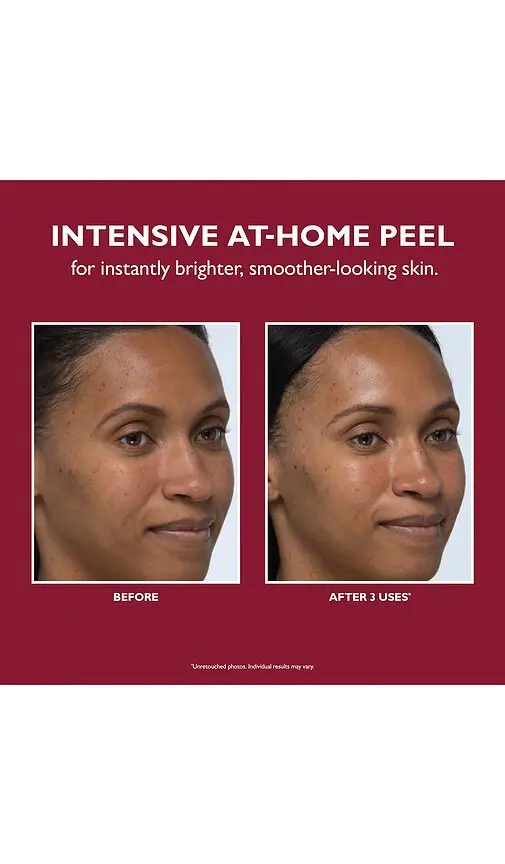 PETER THOMAS ROTH Even Smoother Instant Reveal Facial Peel - N,a