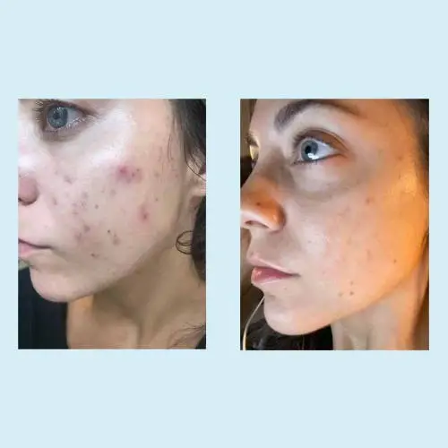 PERFECT IMAGE Tri-clarity Peel Pads 25% 30ct