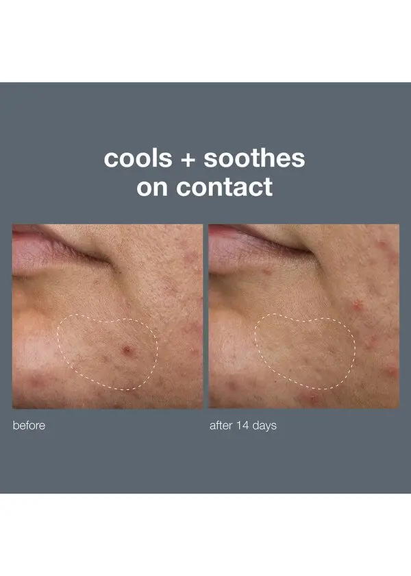 DERMALOGICA Liquid Patch Acne Treatments, Breakout Help