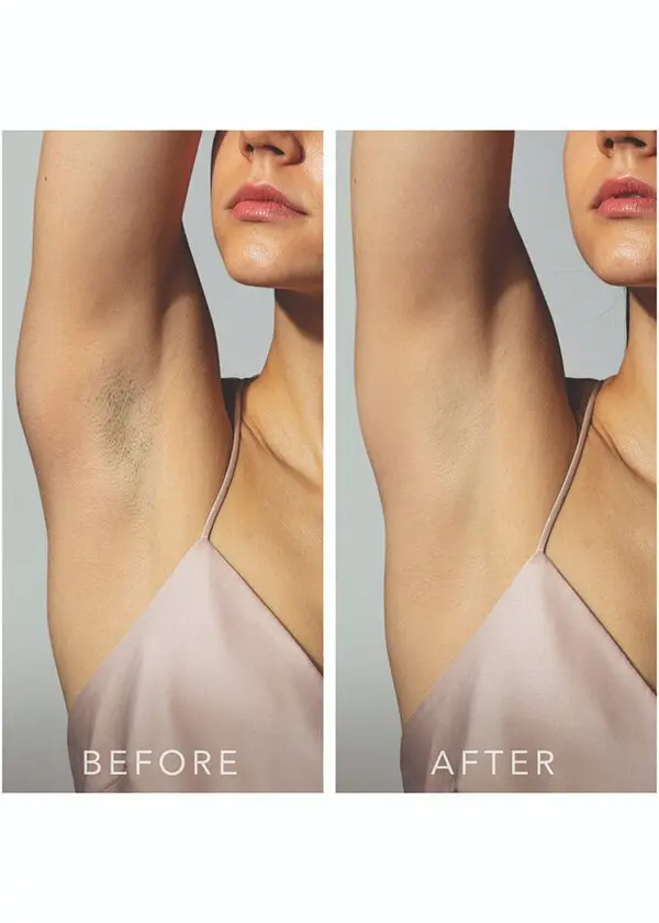 Foreo Peach Advanced Ipl Hair Removal Device, Aerosols, Lace