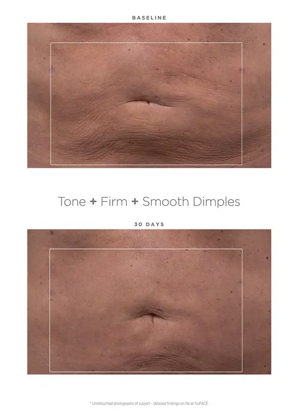 NUFACE Nubody Skin Toning Device