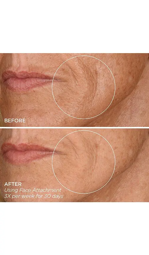 BEAUTYBIO Glopro Face Microtip Attachment