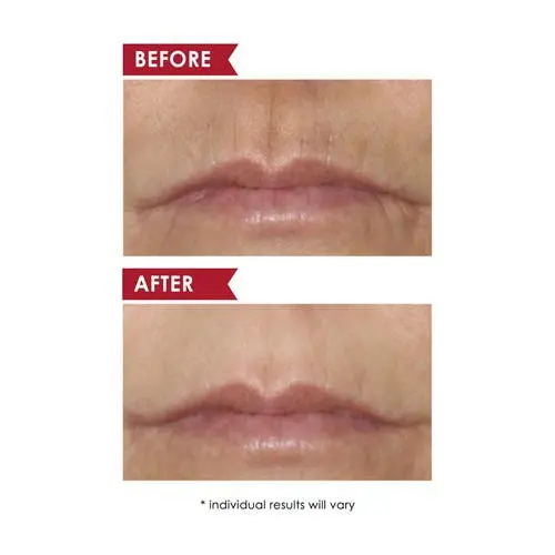 DERMELECT Smooth Upper Lip Professional Perioral Anti-aging Treatment - White