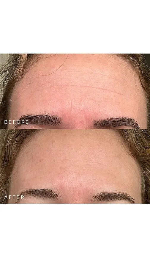 DERMACLARA Forehead Occlusion Patch