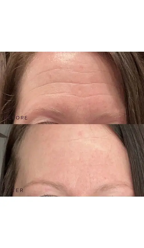 DERMACLARA Forehead Occlusion Patch