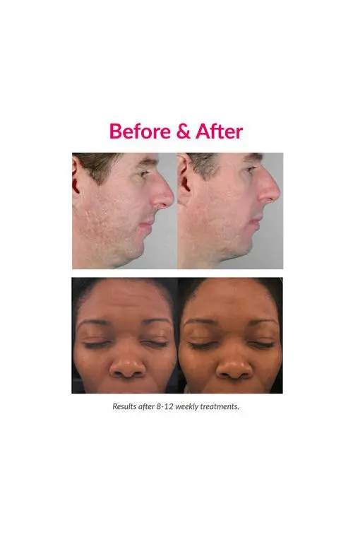 Pmd Personal Microderm Elite Pro Exfoliation Device - Sky