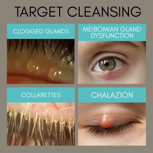 WE LOVE EYES Mgd & Chalazion Cleansing System