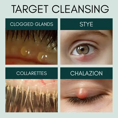 WE LOVE EYES Stye Cleansing System