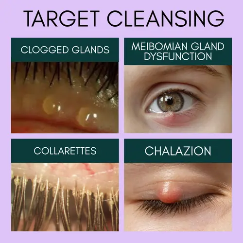 WE LOVE EYES Mgd & Chalazion Systemno Tea Tree Oil