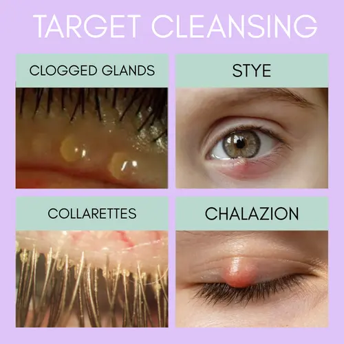 WE LOVE EYES Stye Cleansing Systemno Tea Tree Oil