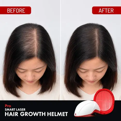 PURSONIC Pro Smart Laser Therapy Hair Growth Helmet352 Precision 650nm Lasers With App Control