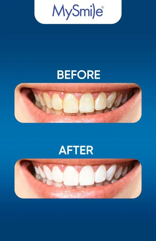 MYSMILE 5x Original Accelerated Teeth Whitening Led Light - Blue