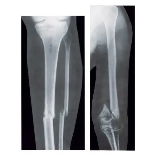 ROYLCO Broken Bones X-rays