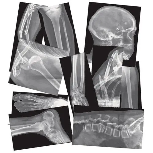 ROYLCO Broken Bones X-rays