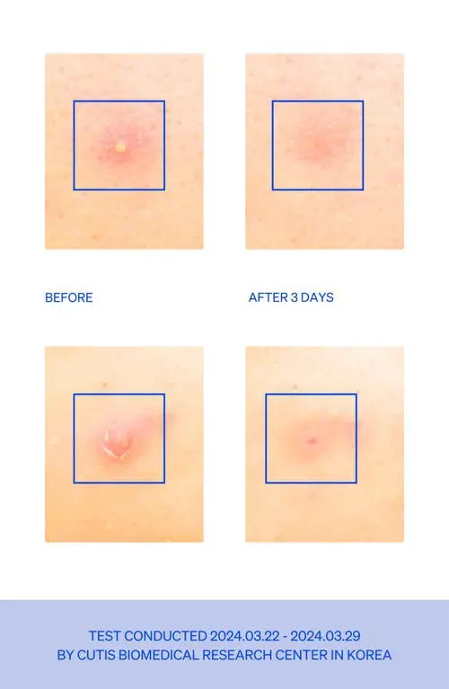 KNEMO Right Away Microtip Spot Patches