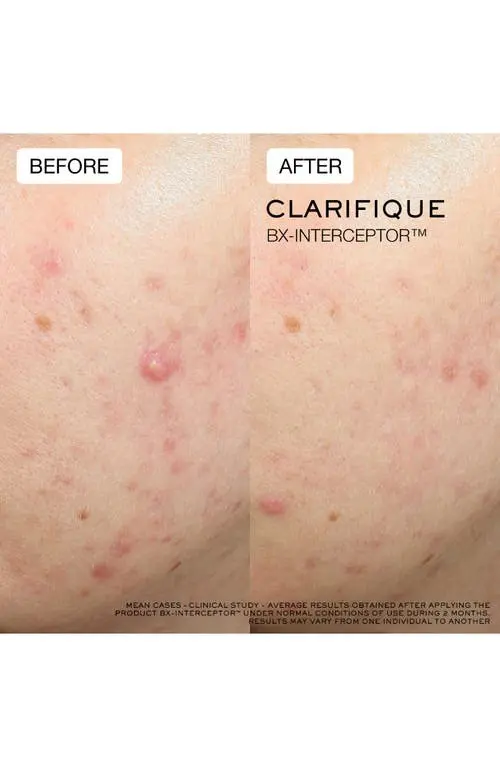 LANCOME Clarifique Bx-interceptor Acne Treatment With Glycolic & Salicylic Acid - No Color