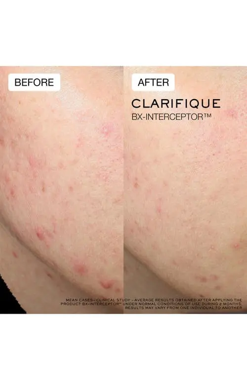 LANCOME Clarifique Bx-interceptor Acne Treatment With Glycolic & Salicylic Acid - No Color
