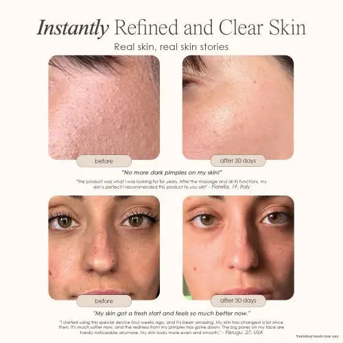 PROJECT E BEAUTY Reinvo Facial Microdermabrasion Wand