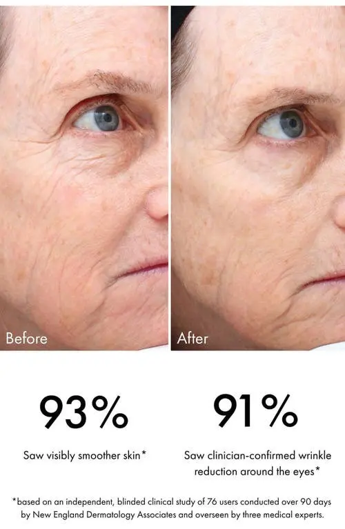 NIRA BEAUTY MISC Pro 3 & Precision 2-piece Laser Setanti-aging Wrinkle Reduction