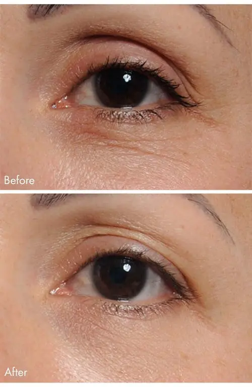 NIRA BEAUTY MISC Pro 3 & Precision 2-piece Laser Setanti-aging Wrinkle Reduction