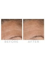 Microneedling_0013_1 GloPRO® Microneedling Regeneration Tool BEAUTYBIO before and after