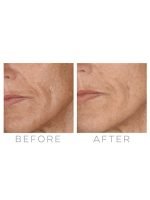 Microneedling_0013_1 GloPRO® Microneedling Regeneration Tool BEAUTYBIO before and after